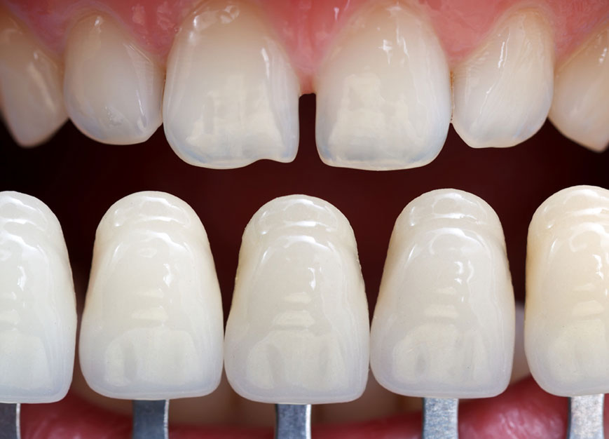 Zahn Veneers von UNIQSMILE® I UNIQAESTHETICS®